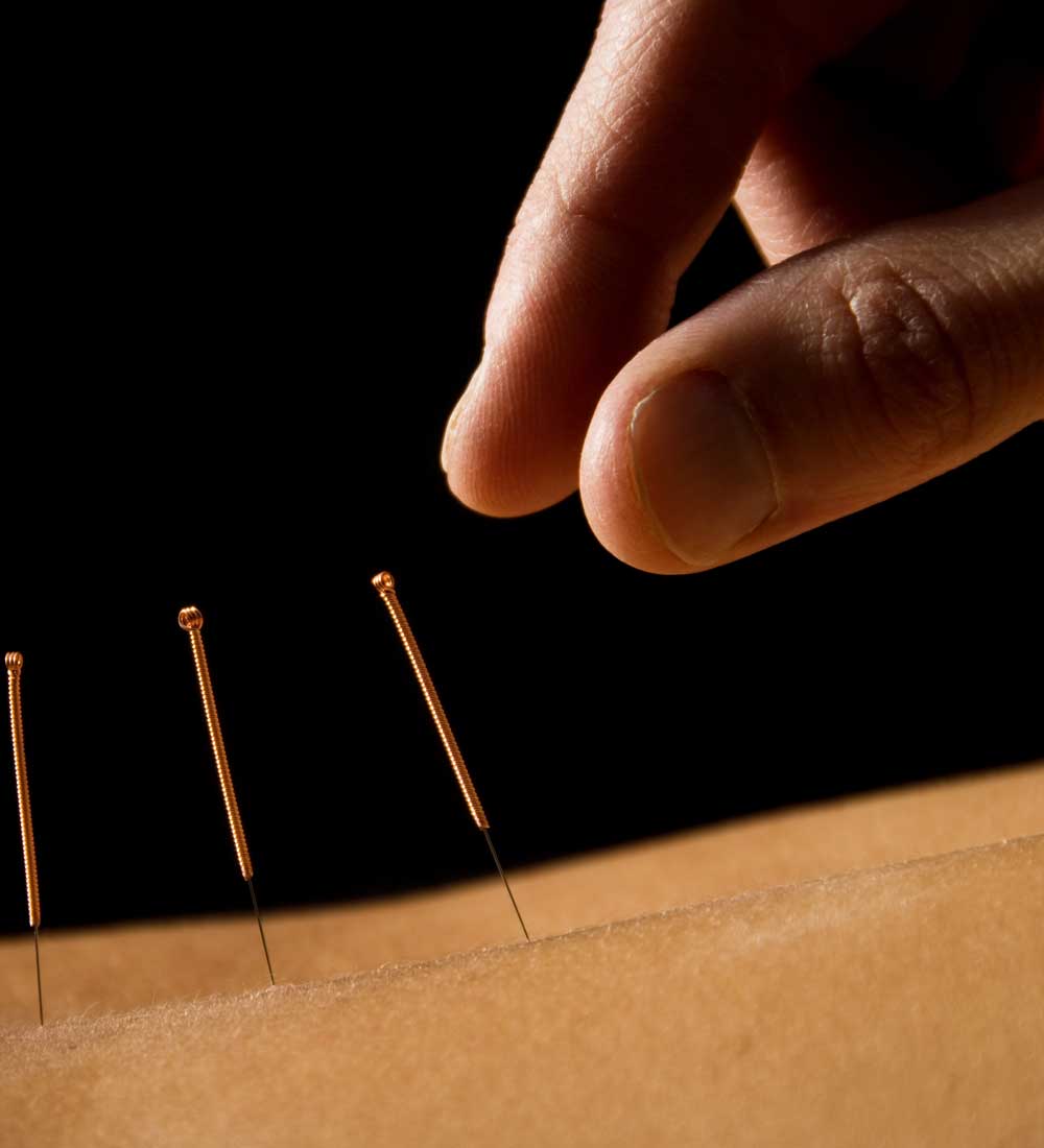 Acupuncture - North Star Health Services